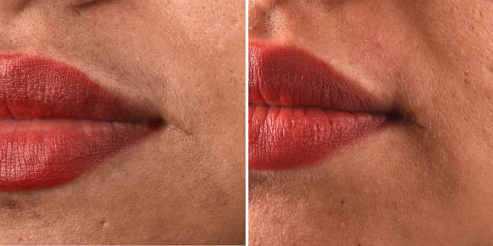 Laser Hair Removal Ras Al Khaimah | Trusted Laser Clinic